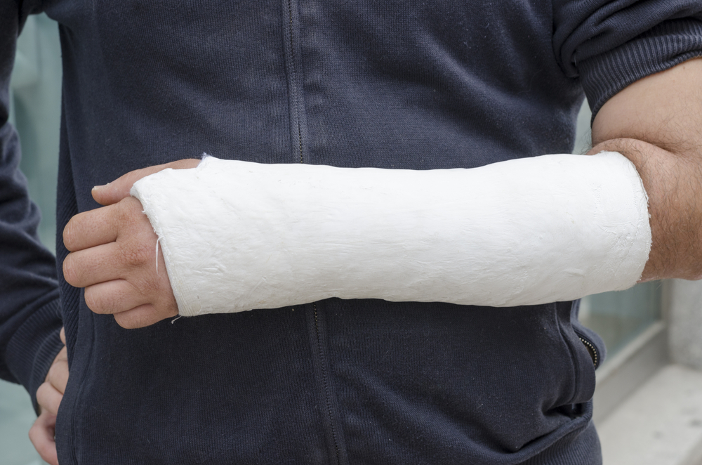 Broken Bones Cast